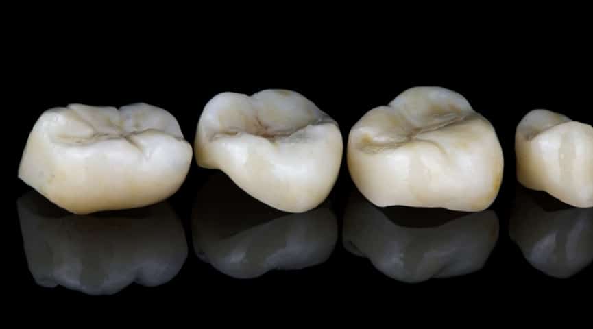 Dental Crowns: The Smart Fix for Cracked Teeth